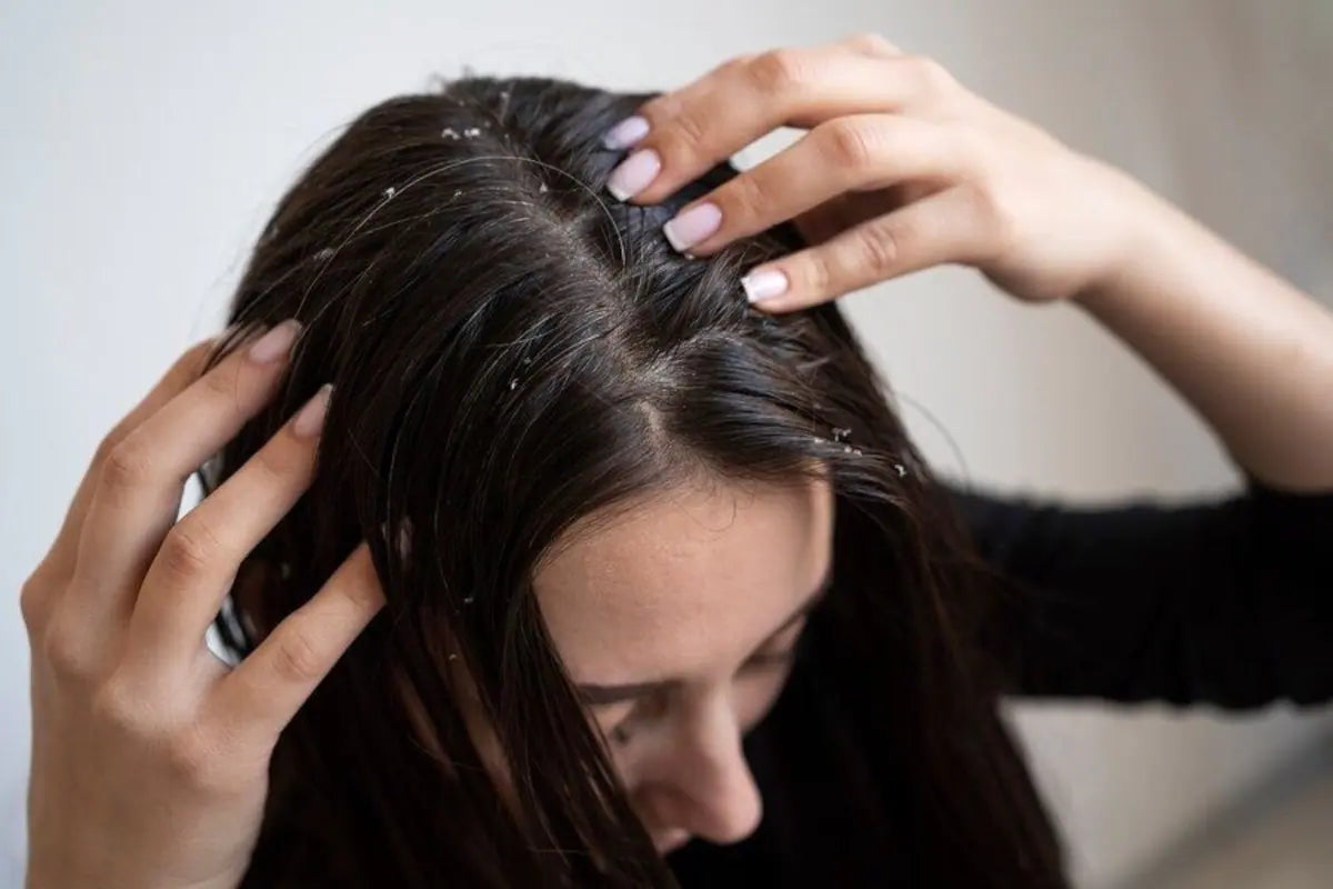 How to Care for Dandruff – Concept Cosmetics